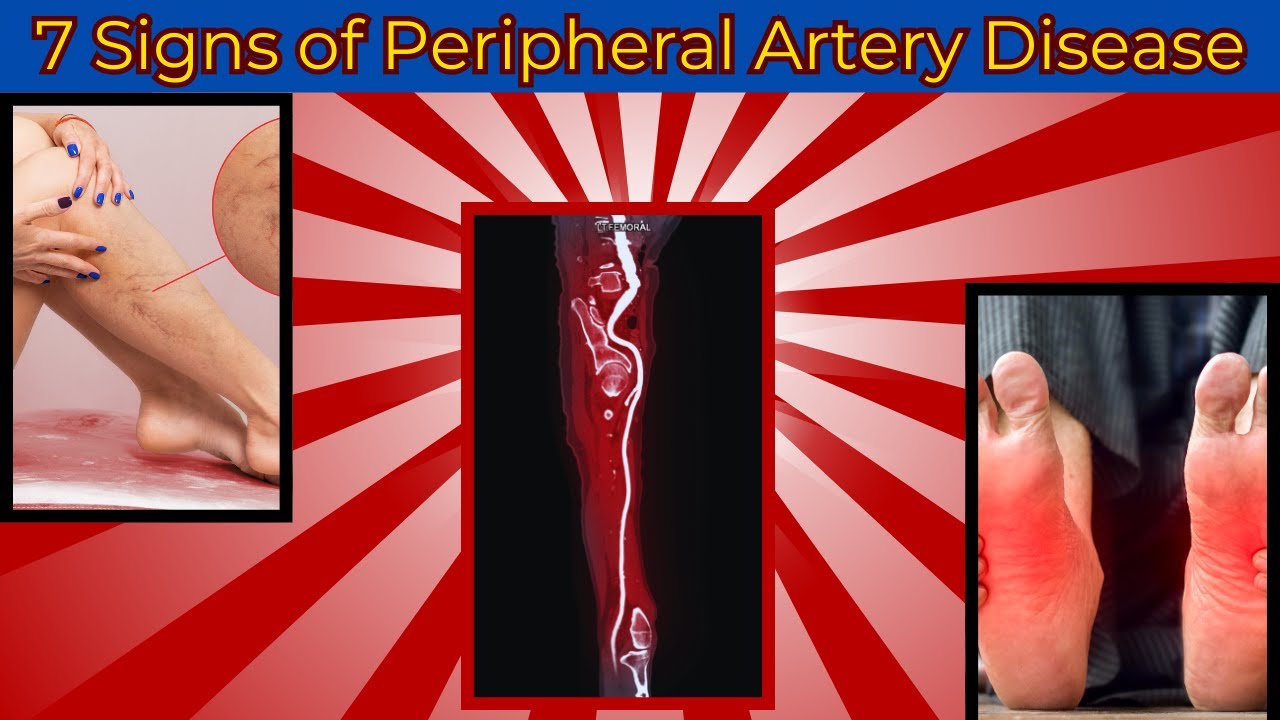Peripheral Artery Disease: Warning Signs You Shouldn't Ignore - YouTube