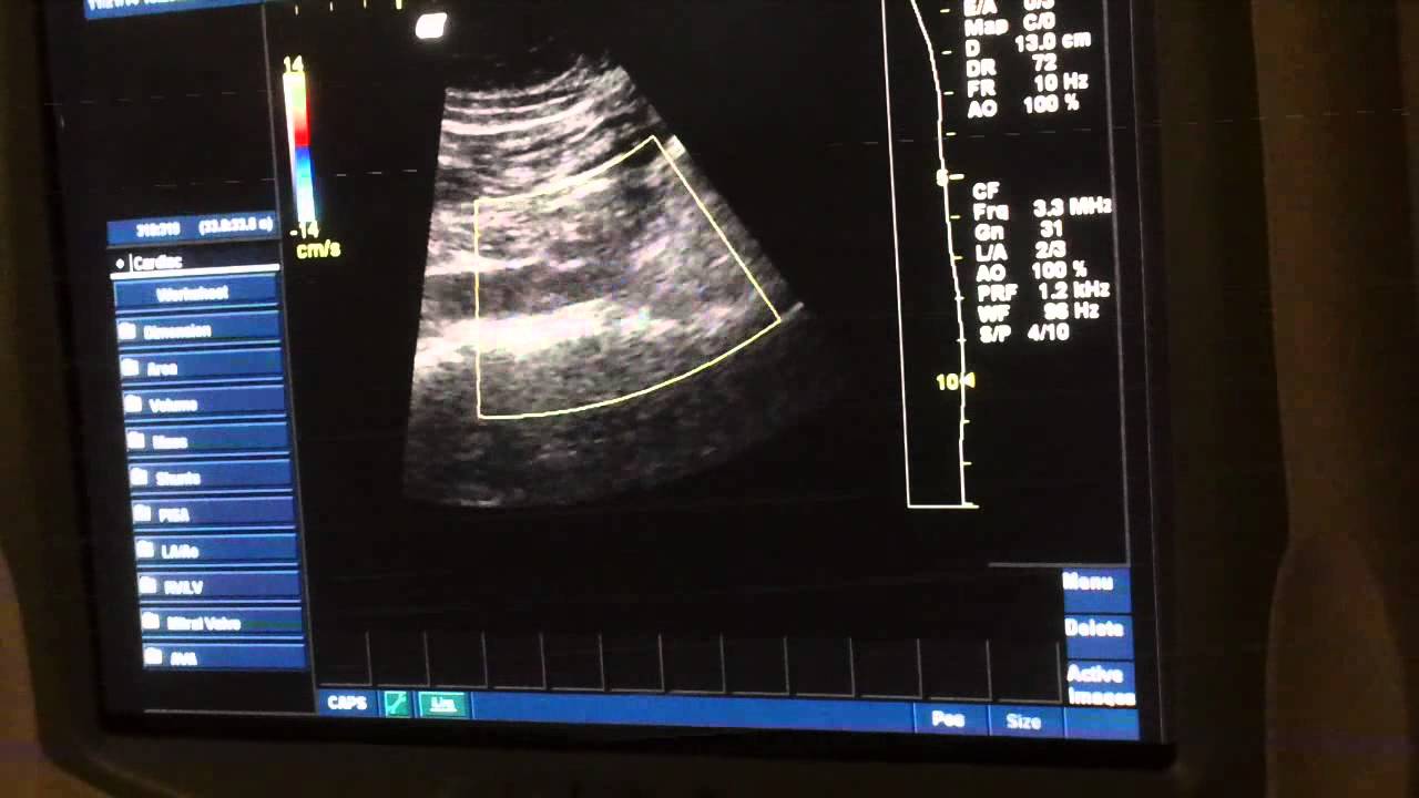 Slide 5: Abdominal Aorta Bifurcation - YouTube