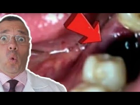 NUNCA EXTRAIA DENTE SISO SEM VER ESSE VÍDEO ANTES - Dr.André Karam