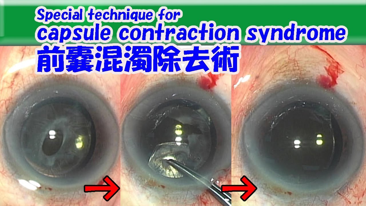 Special technique for Capsule contraction syndrome - YouTube
