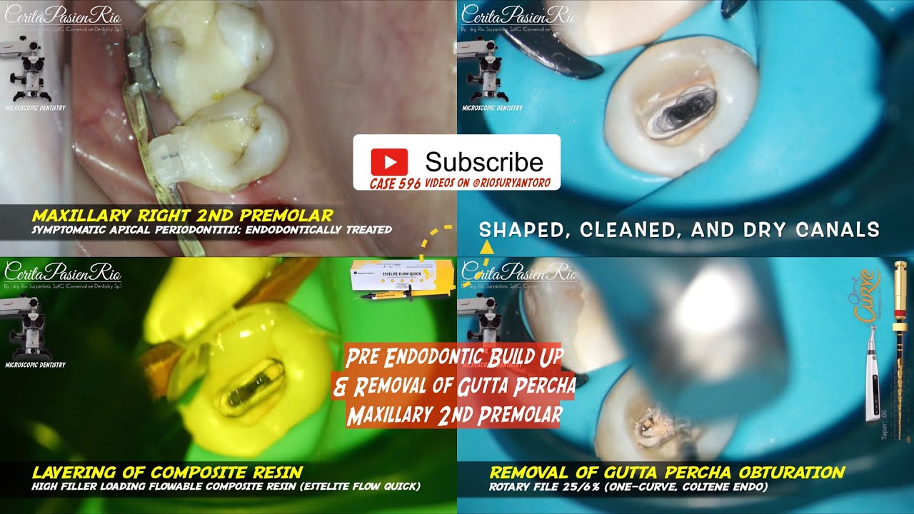 PRE ENDODONTIC BUILD UP & GUTTA PERCHA REMOVAL ENDODONTIC RETREATMENT ...