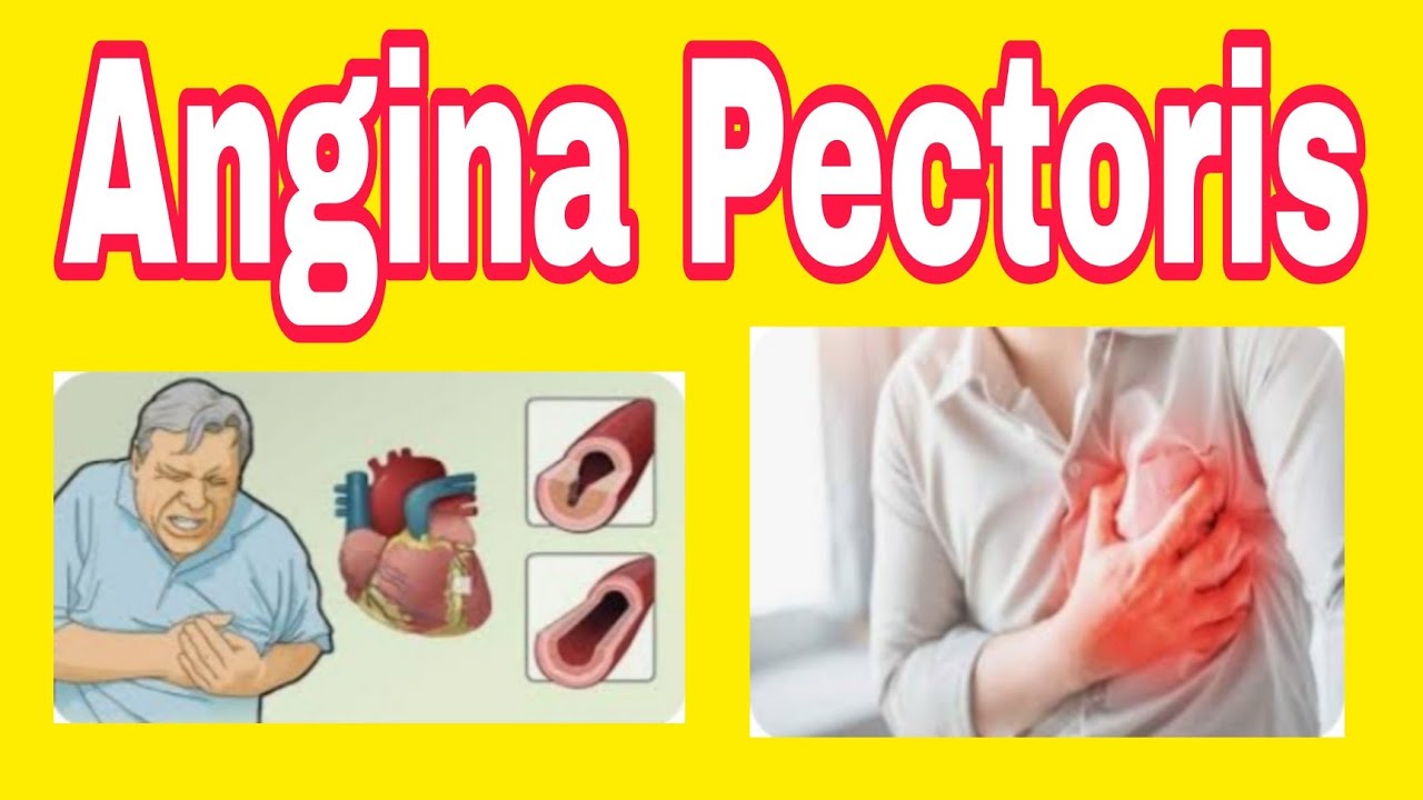 Angina Pectoris |its risk factors |medical and surgical management ...