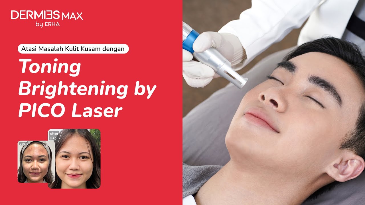BYE WAJAH KUSAM! NEW TREATMENT TONING BRIGHTENING TREATMENT BY PICO LASER - YouTube