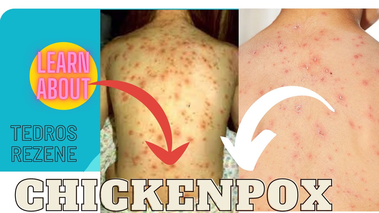 what is Chickenpox (varicella). - YouTube
