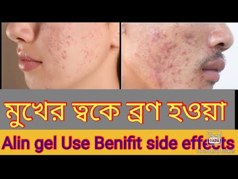 ALIN GEL / ADAPALENE GEL DOSE BENIFITS SIDE EFFECTS FULL REVIEW - YouTube