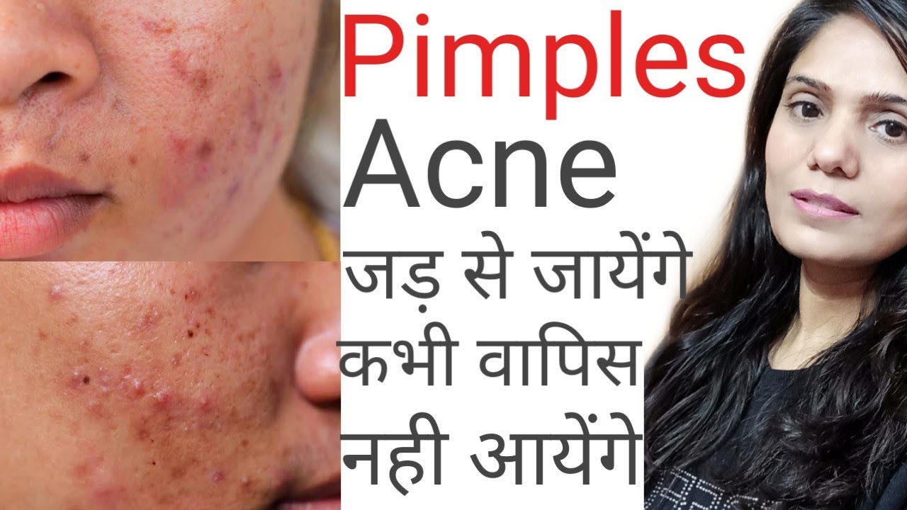 Pimples kaise hataye. Pimples ko jad se kaise khatam kare. Pimples ka ...