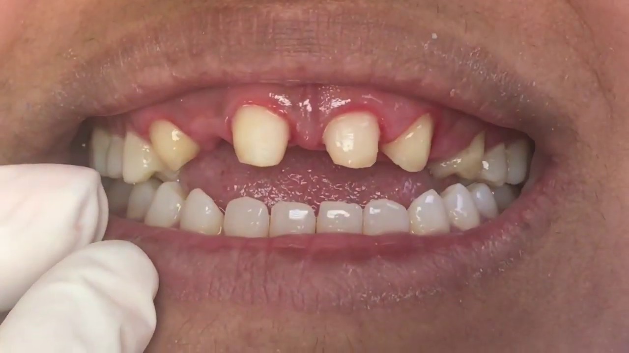 Houston Cosmetic Dentist...Gaps, missing teeth and an open bite...Watch ...