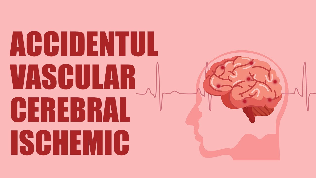 Accidentul vascular cerebral ischemic: simptome care, depistate la timp ...
