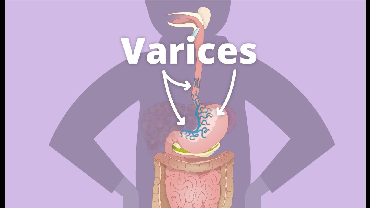 Cirrhosis – Varices - YouTube