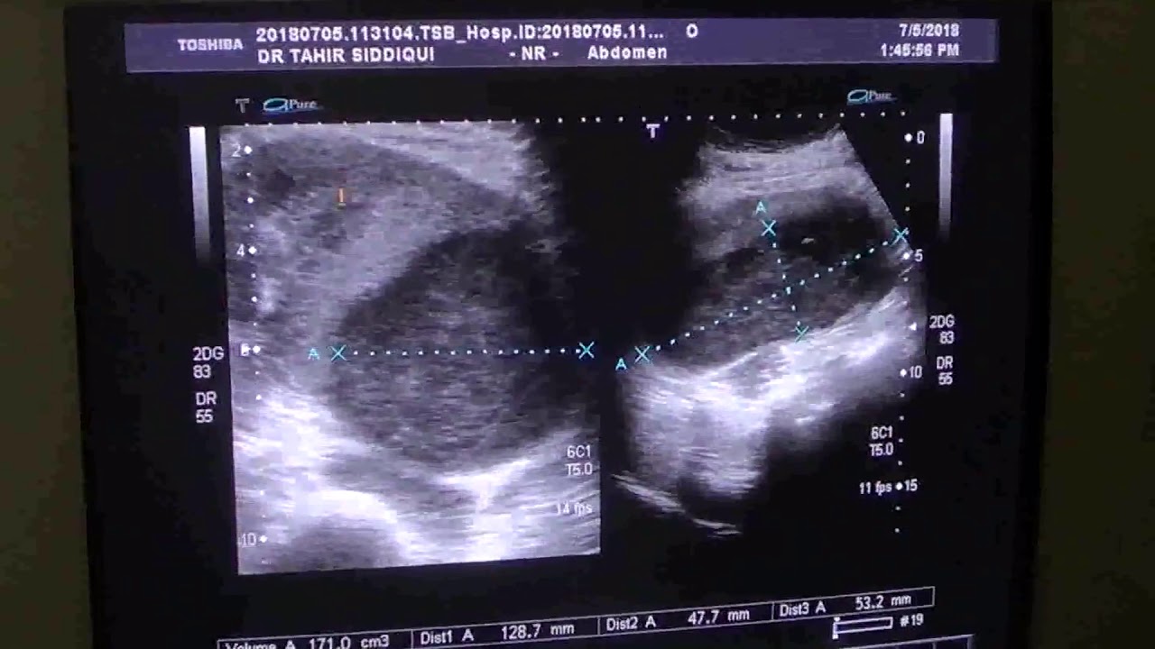 RENAL ABSCESS with PYELONEPHRITIS - YouTube