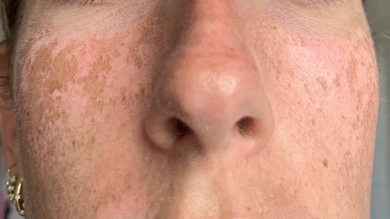 How To Get Rid Of Peeling Skin On Face From Sunburn Fast YouTube how-to-get-rid-of-peeling-skin-on-face-from-sunburn-fast-youtube