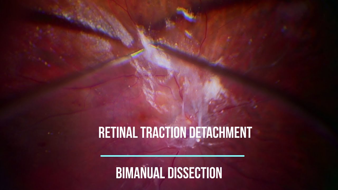 Bimanual dissection in Diabetic traction detachment - YouTube