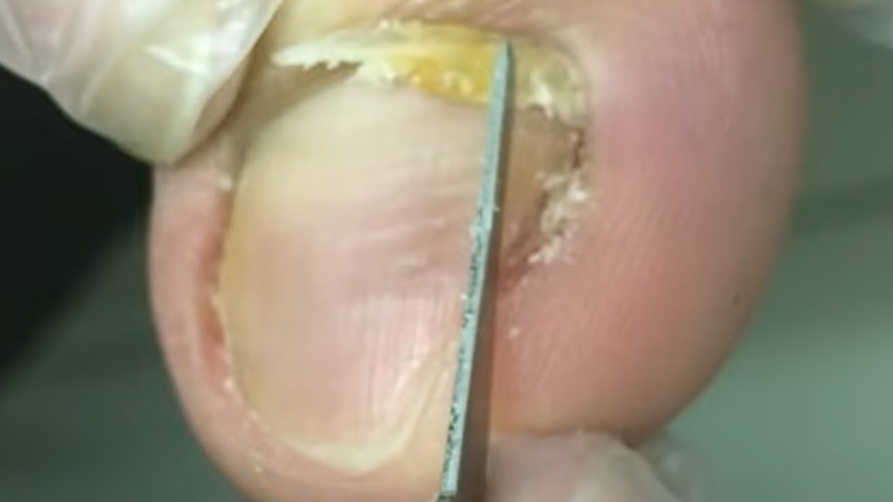 Ingrown Nails with Crowded Roots, Treat It【Dr. Zhang】 - YouTube