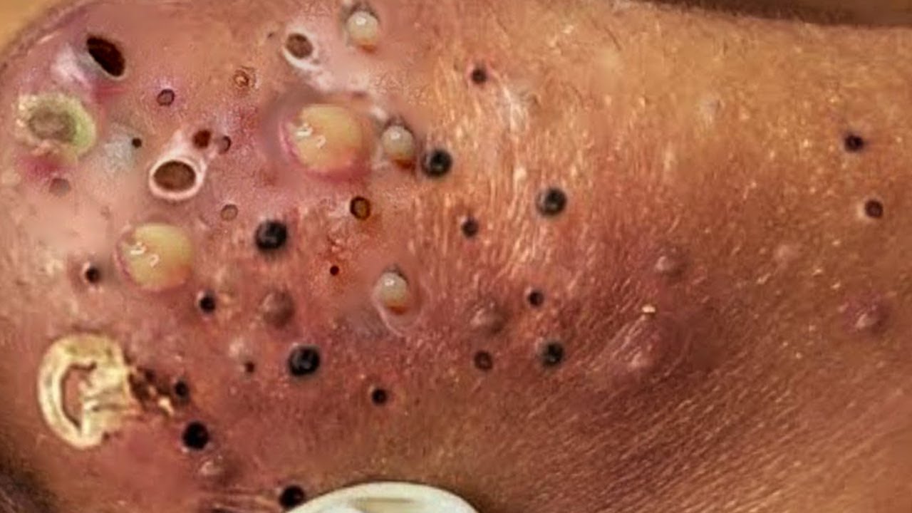 Close-Up Blackhead Removal from Deep Facial Pores #025 - YouTube