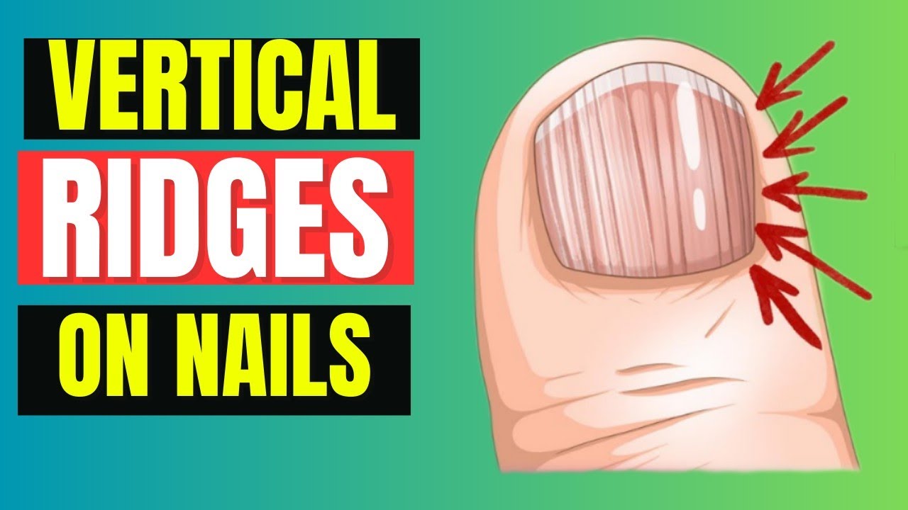 The REAL Causes of VERTICAL RIDGES On Your Nails - YouTube