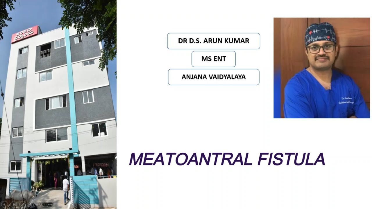 MEATOANTRAL FISTULA - Dr ARUN KUMAR MS ENT - YouTube