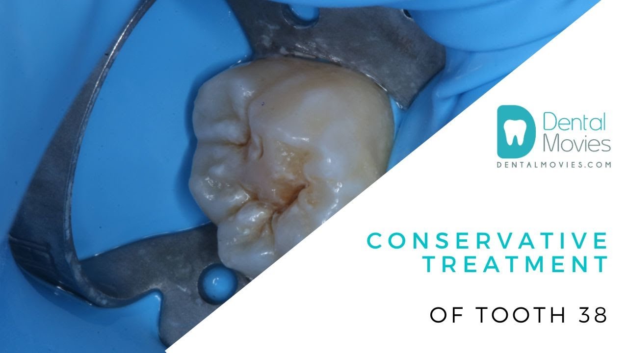 Conservative treatment of tooth 38 - YouTube