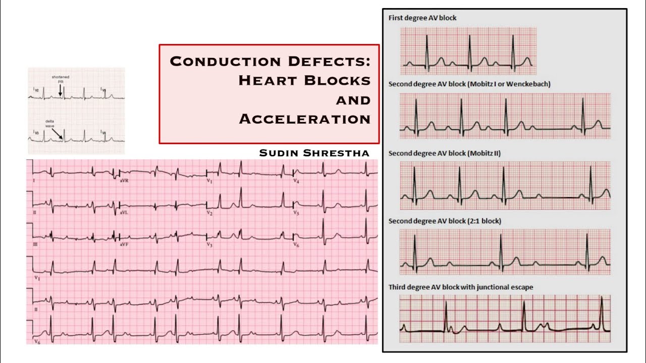 Conduction Defect- Heart Block & Acceleration | Cardio-Physiology ...