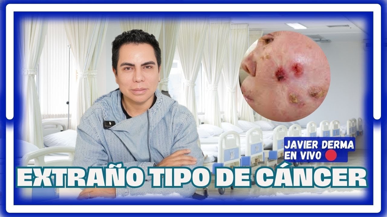 ¿ES POSIBLE TENER CÁNCER DE PIEL SINO ME EXPONGO AL SOL? I JAVIER DERMA ...