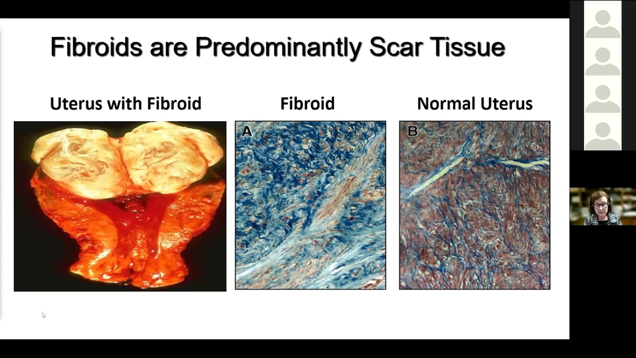 Fibroids as a Female-Specific Chronic Debilitating Condition by William ...