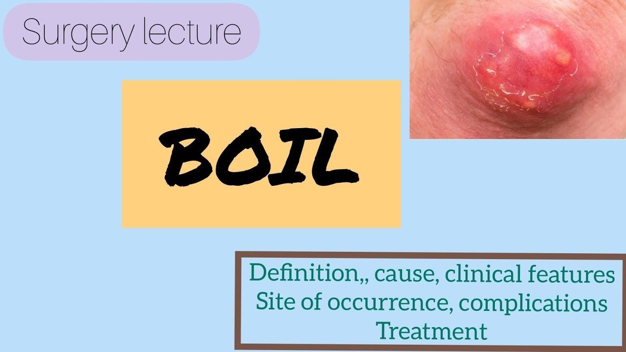 BOIL - surgery lecture / by a young homoeopath - YouTube