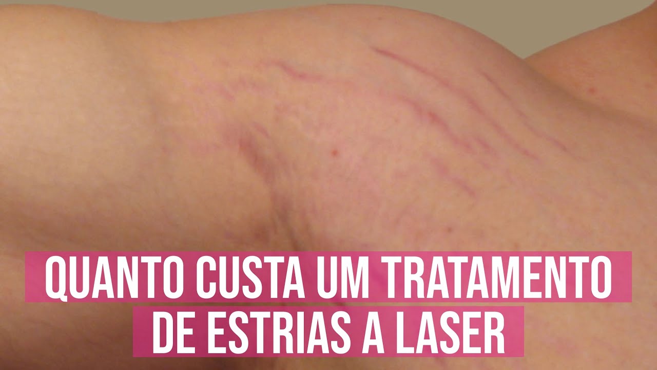 Quanto Custa um Tratamento de Estrias a Laser - YouTube