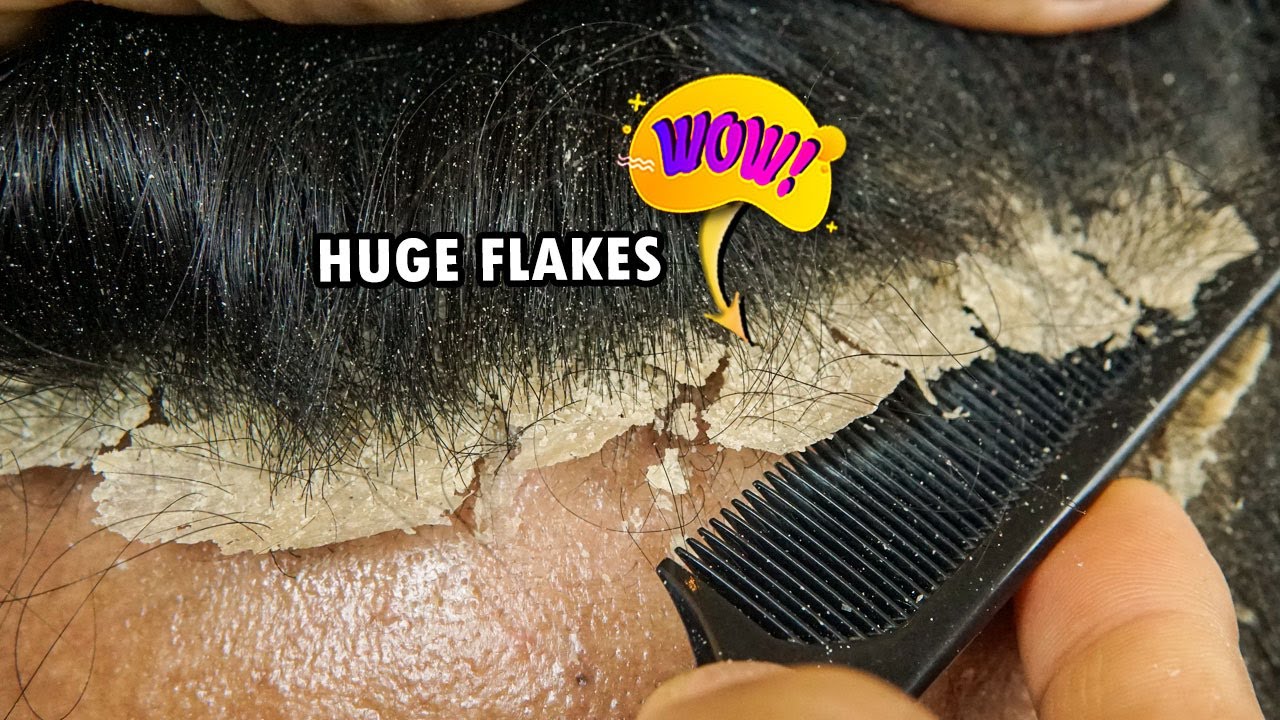 Dry Huge Flakes Removal From Dandruff Scalp #741 - YouTube
