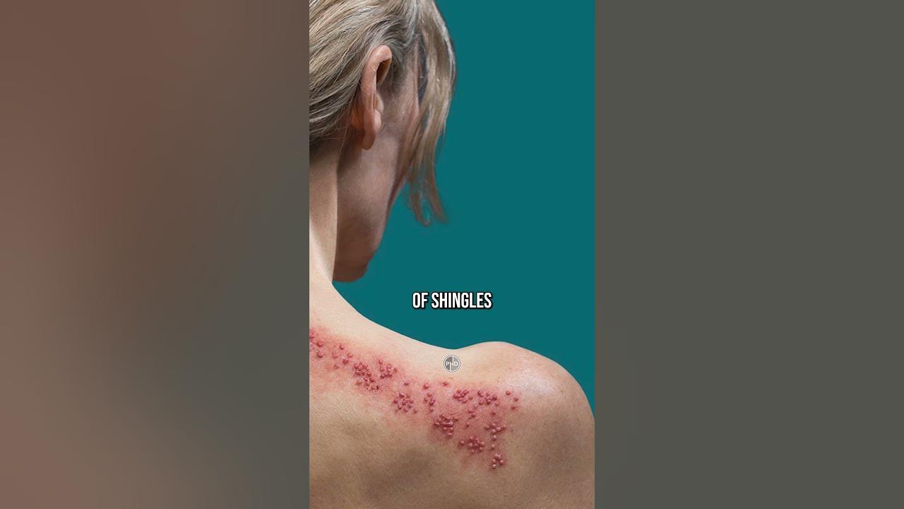 Can You Reduce Shingles On The Carnivore Diet YouTube can-you-reduce-shingles-on-the-carnivore-diet-youtube