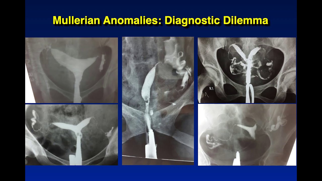Surgical Management of Mullerian Anomalies - YouTube