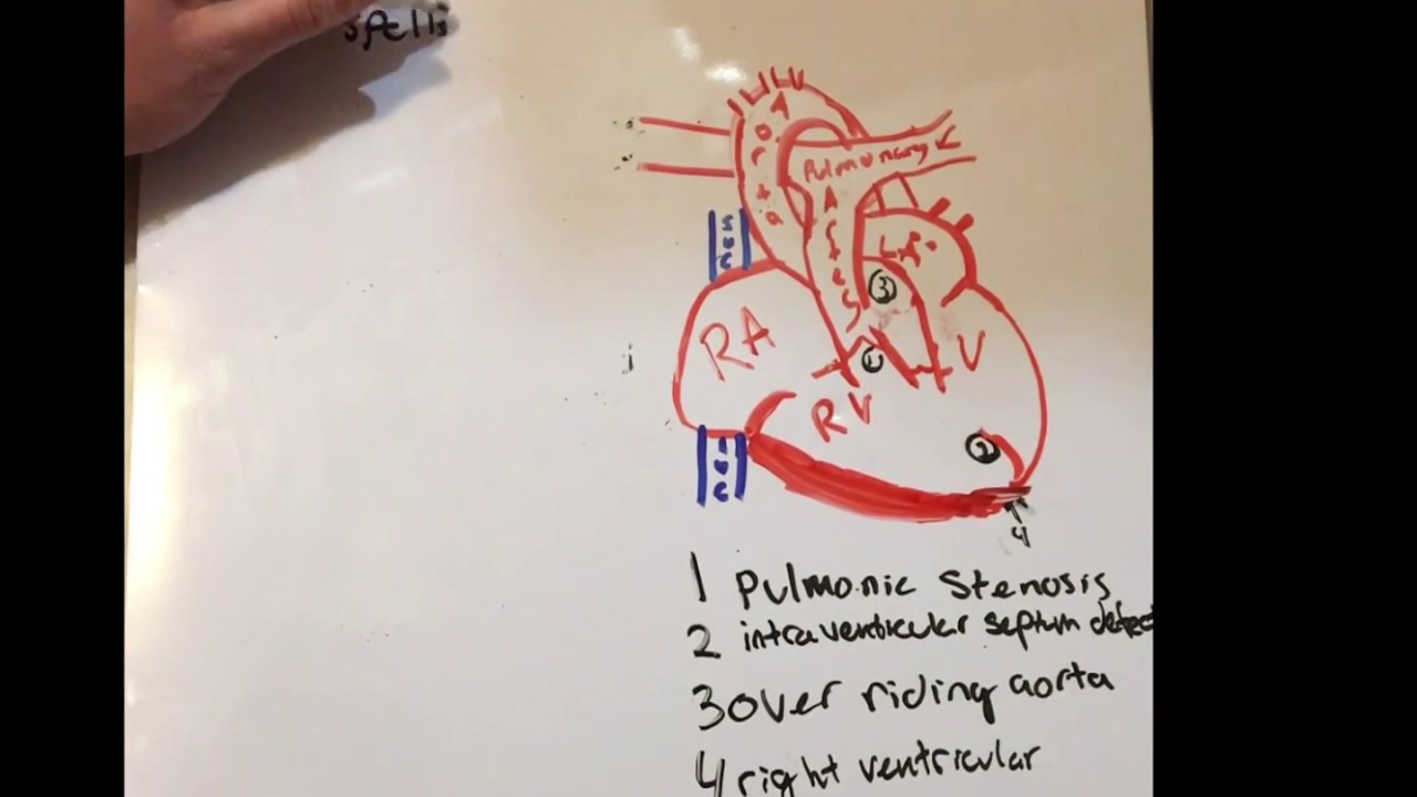 Tetrology of Fallot - YouTube