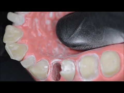 Preparo inlay e onlay - pré molar - YouTube