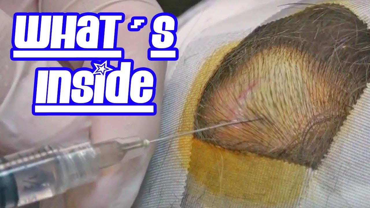 What's Inside This Pilar Cyst? Pimples, Cysts & Dilated Pores! - YouTube