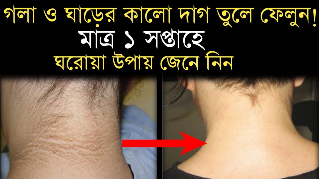 গলা ও ঘাড়ের কালো দাগ দূর করার ঘরোয়া উপায়-gharer Kalo Dag Dur korar ...