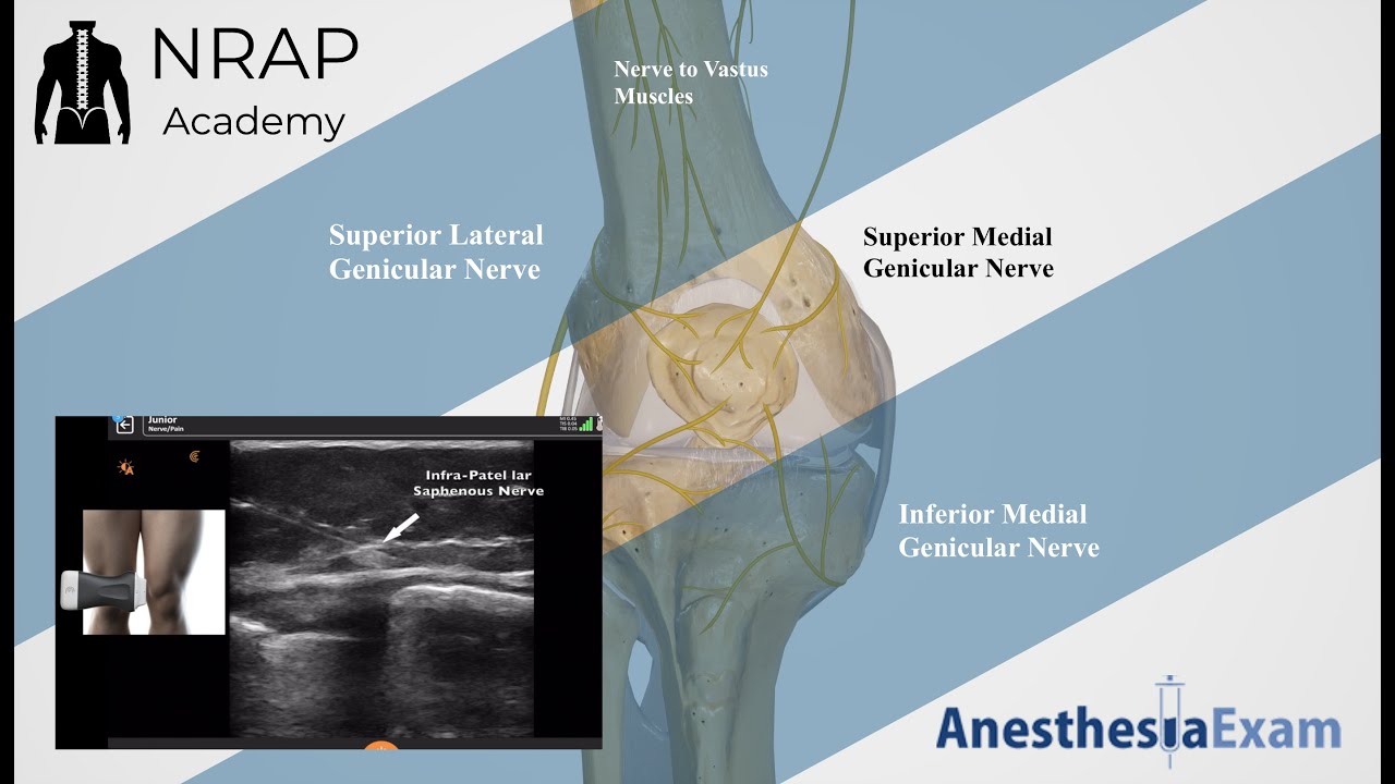 NRAP Academy: Anterior Femoral Cutaneous 3 Branches and Intra-Patellar ...