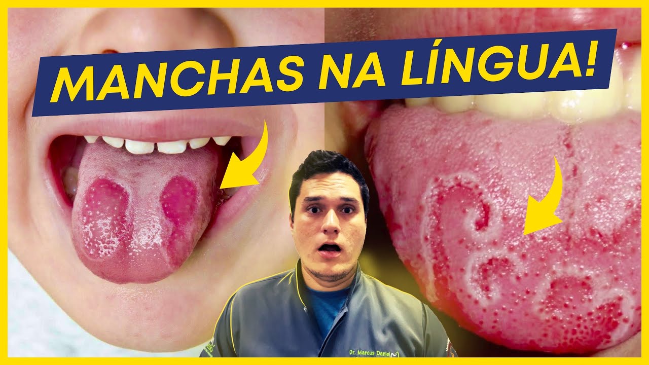 LÍNGUA BRANCA com MANCHAS VERMELHAS: O que pode ser? - YouTube