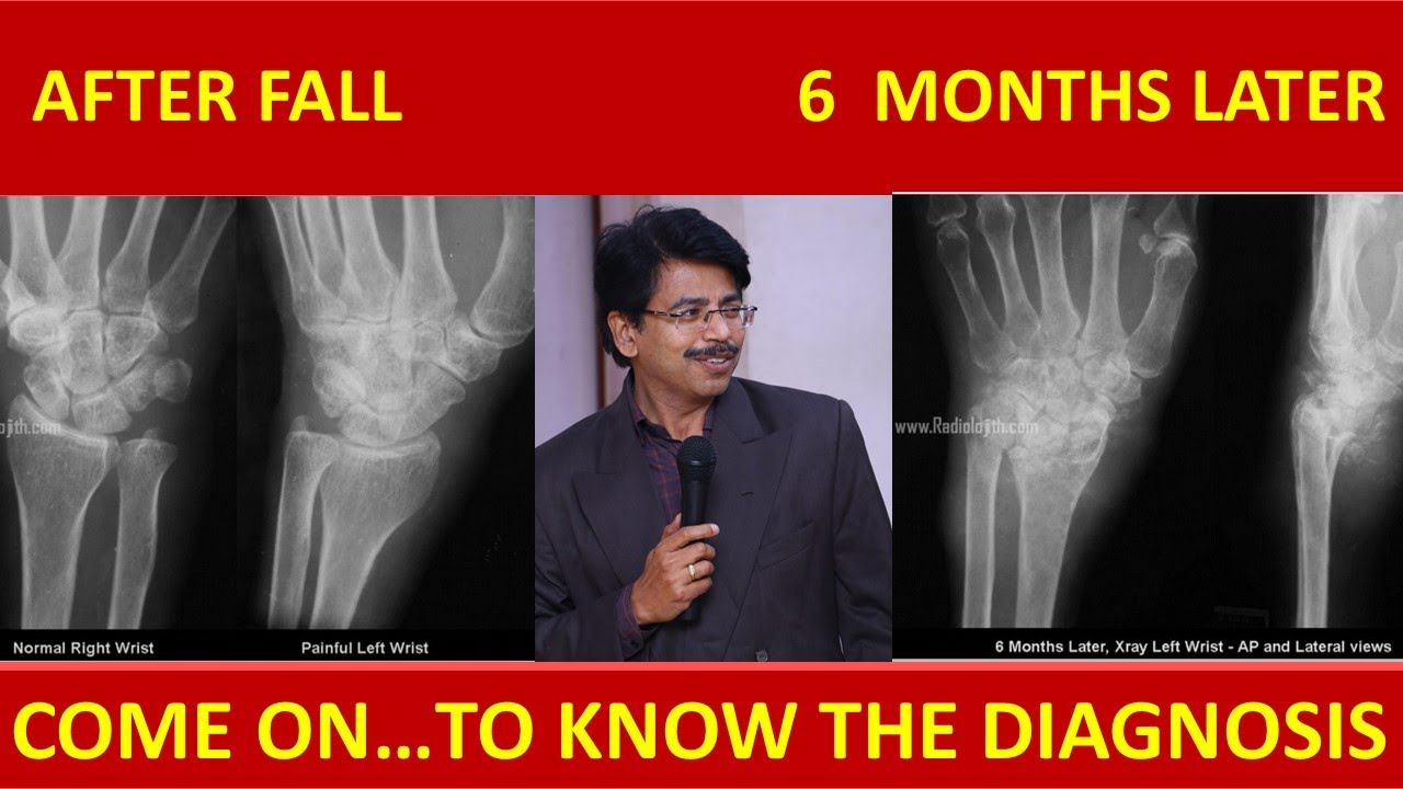 60 YEAR OLD LADY WITH TRIVIAL INJURY IN THE LEFT HAND. GIVEN XRAY AND ...