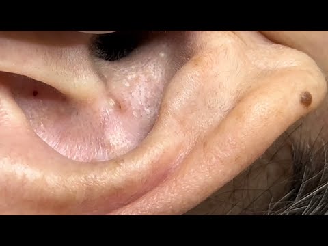 Milia inside the ear. - YouTube