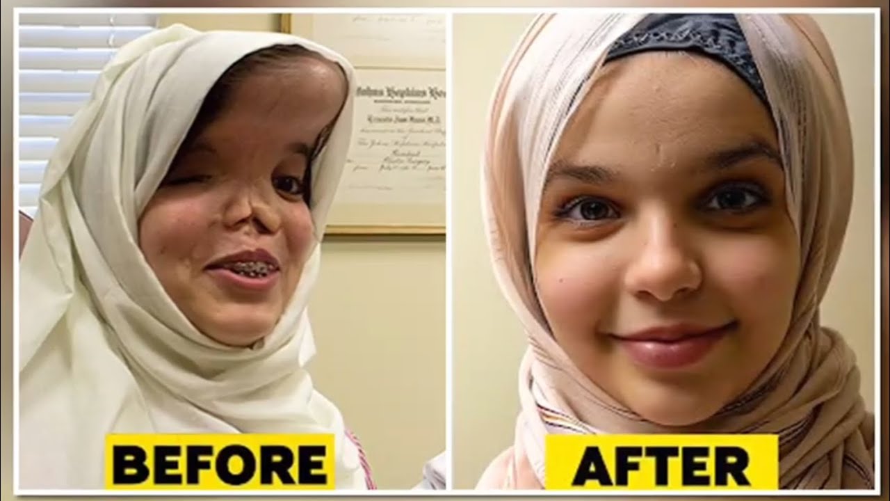 Kids Who Had Extreme Plastic Surgery _ Before and After Plastic Surgery ...
