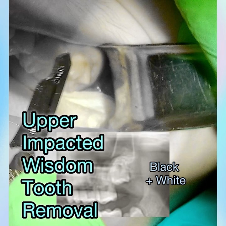 Upper Impacted Wisdom Tooth Removal - YouTube