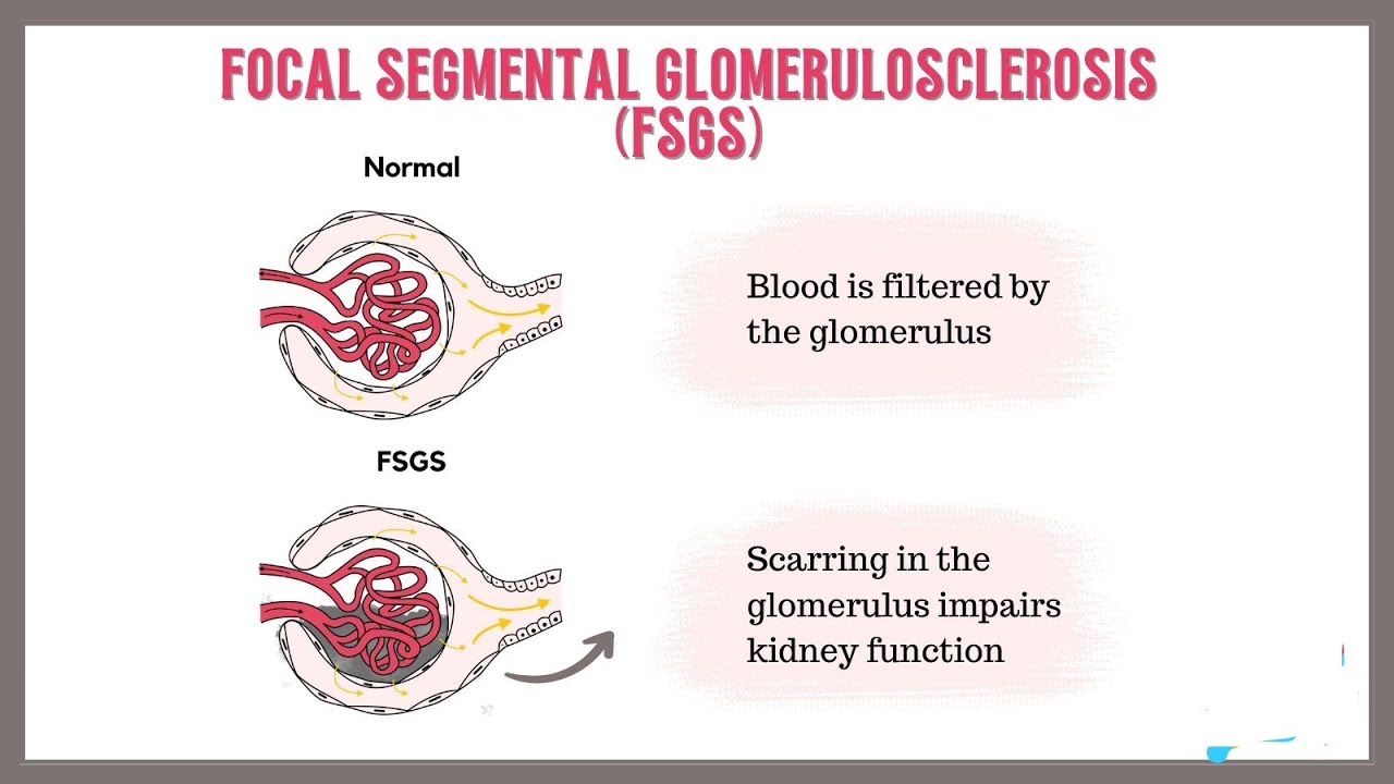 Focal Segmental Glomerulosclerosis (Kidney Scarring Disorder ...