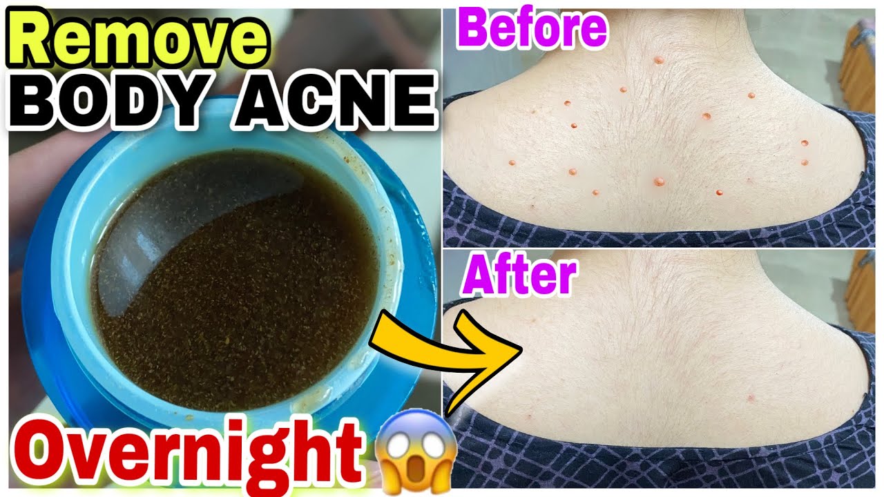 How I Got Rid Of My Back Acne Overnight | Homemade Lotion To Remove ...
