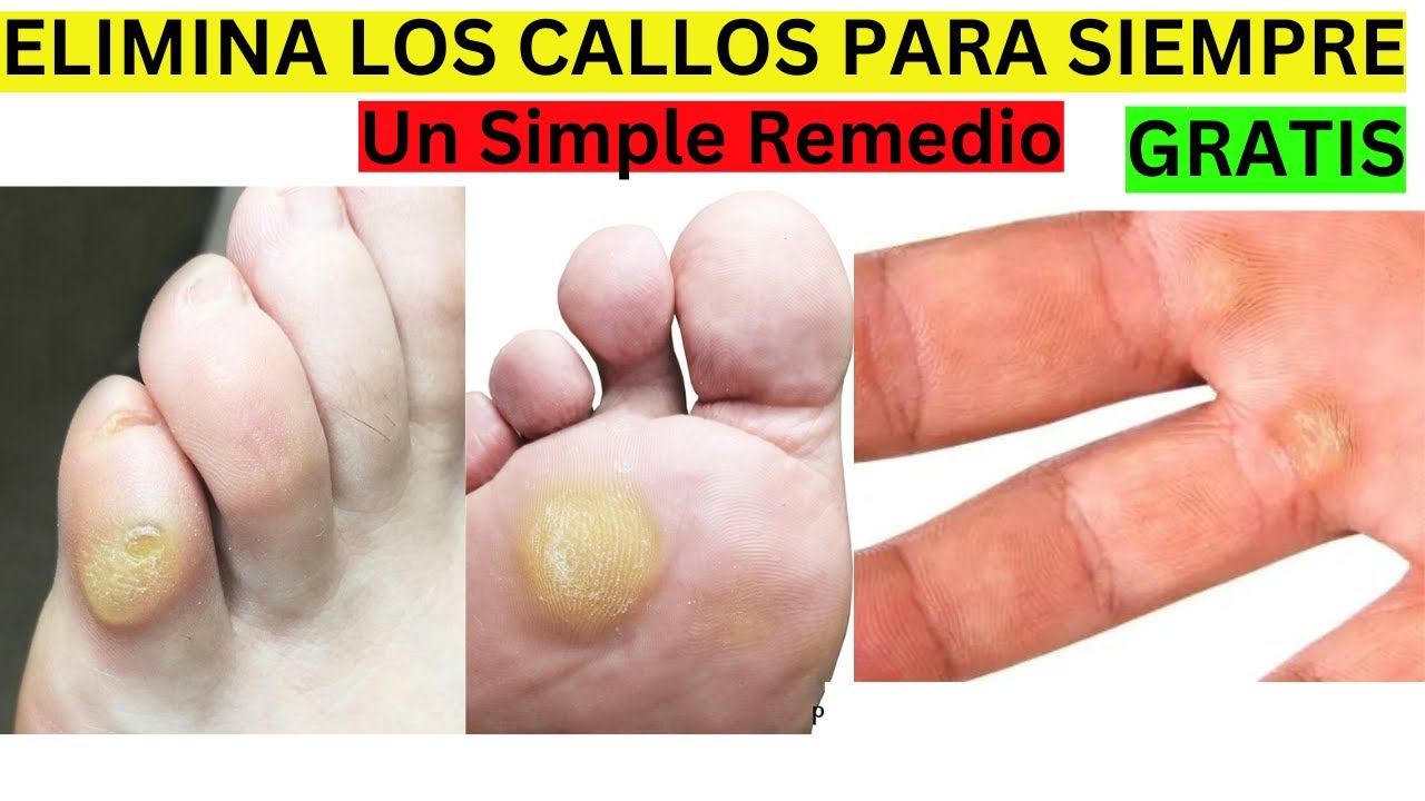 ¡Como Eliminar los callos de los pies para siempre con este sencillo ...