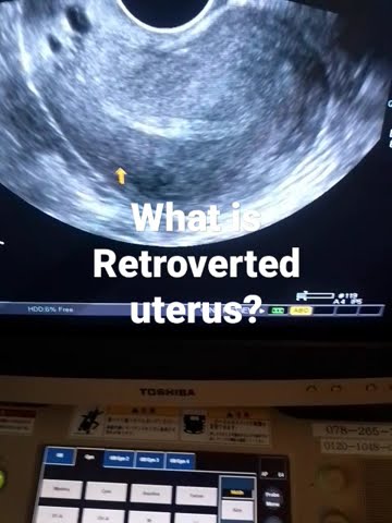what is Retroverted uterus??and how looks on tvs ultrasound - YouTube