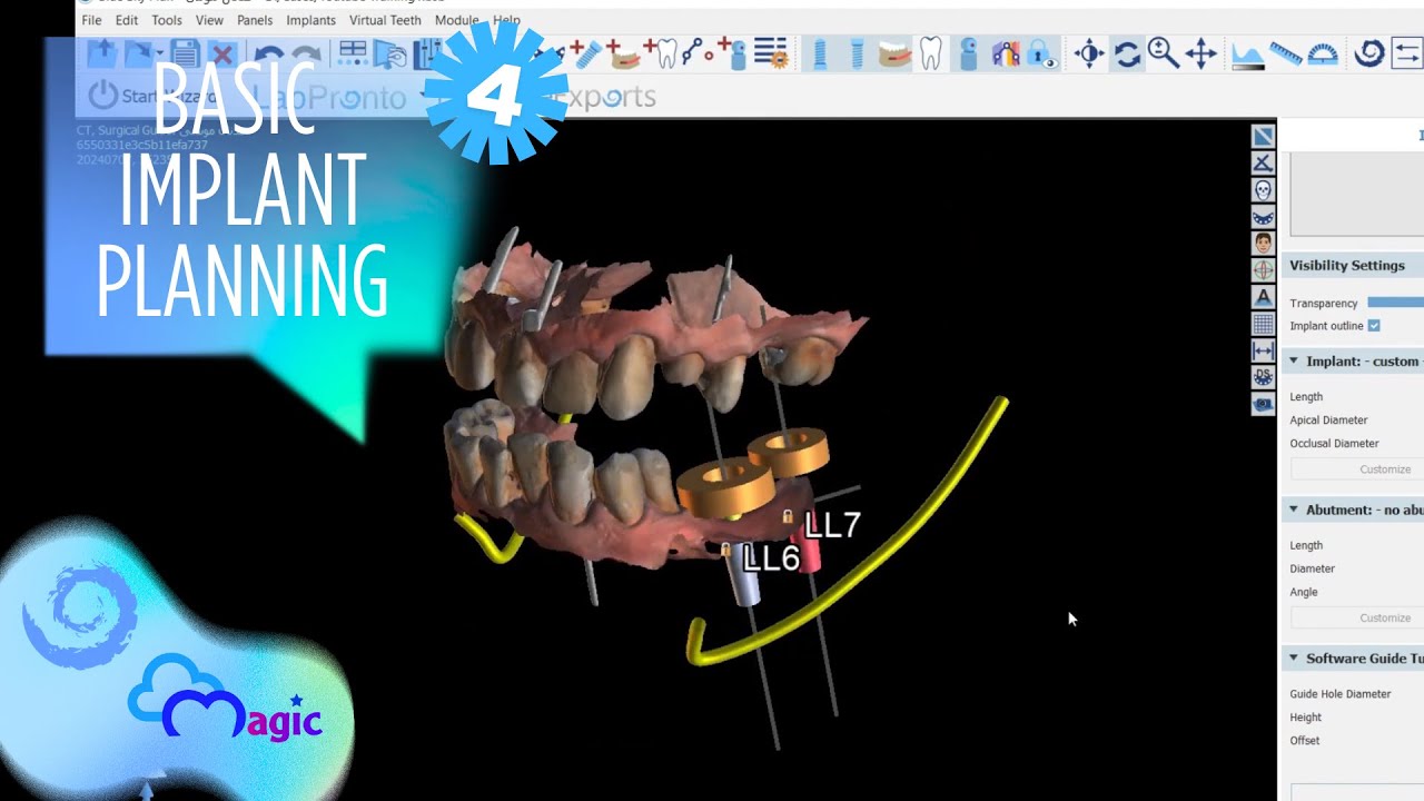 Blue Sky software / Basic Implant Planning - YouTube