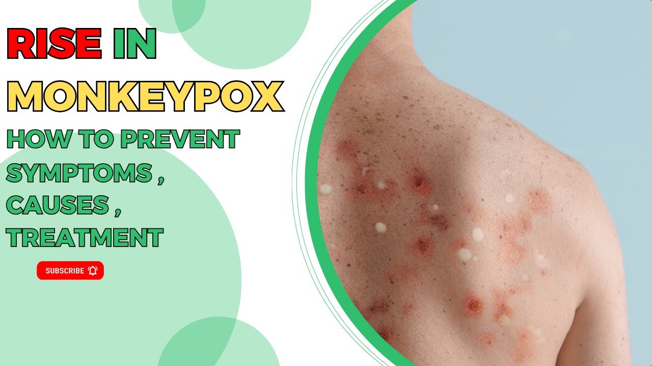 Rise In Monkeypox || How To Prevent It ? || Symptoms , Causes ...