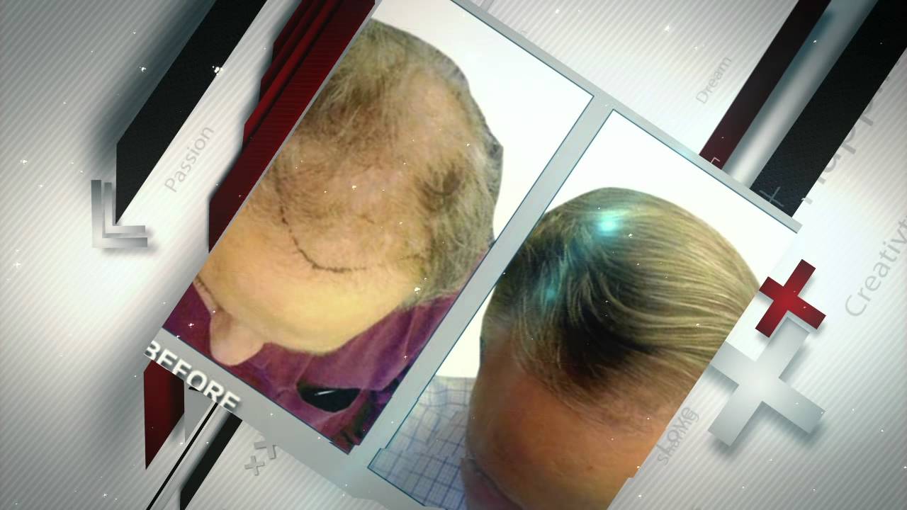 Battle Back Hair Loss With Virginia Surgical - YouTube