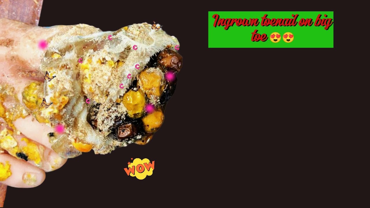 Trim ingrown toenails like horns😭 inverted toenails😭 toenail fungus d.r ...