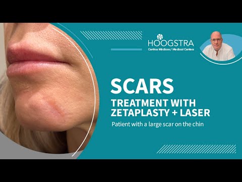 Large scar on the chin treated with zetaplasty + laser - 25086 - YouTube