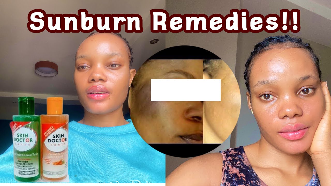 Tips : How To Get Rid Of Sunburn/ Products That Work For Sunburn - YouTube