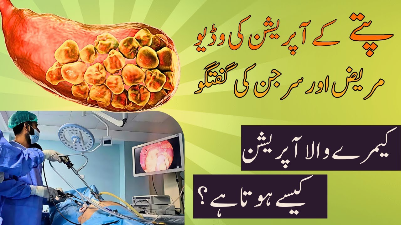 SECRET to Successful Laparoscopic Gallbladder Stone Surgery - YouTube